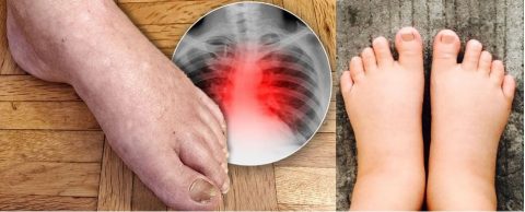 Picioare umflate (edemele) - Clinica de cardiologie Cardioclass